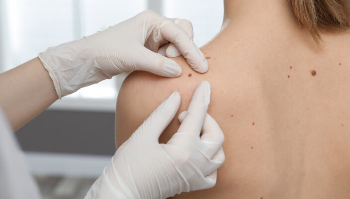 A Comprehensive Guide To Total Body Skin Exams Center For Surgical